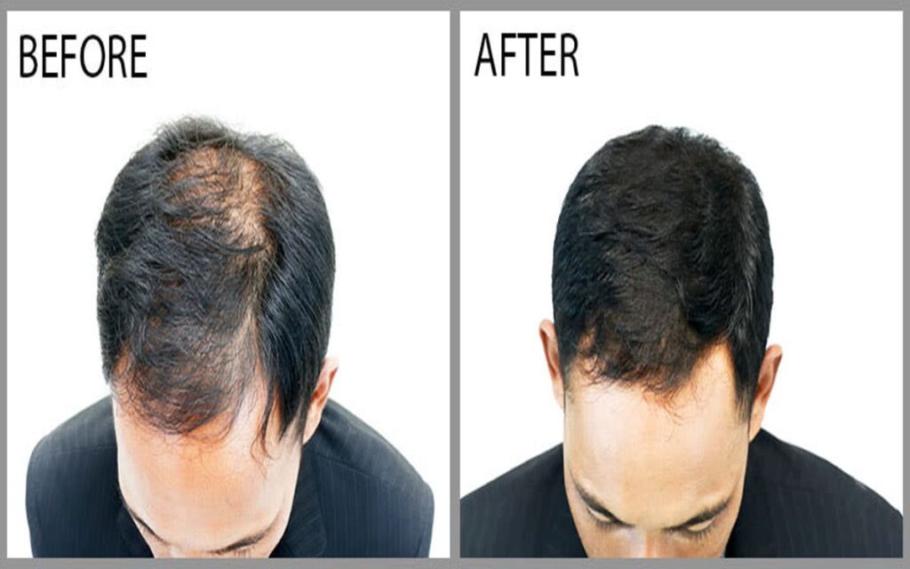 Best Hair Regrowth Treatment For Men 2025 Ultimate Guide